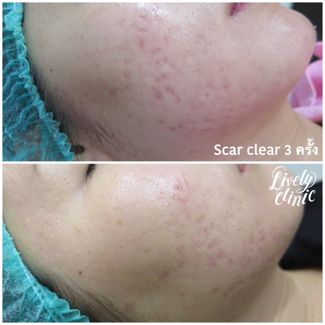 Scar Clear ตัดพังผืดสาเหตุของหลุมสิว แก้ไขปัญหาหลุมสิว - Lively Clinic