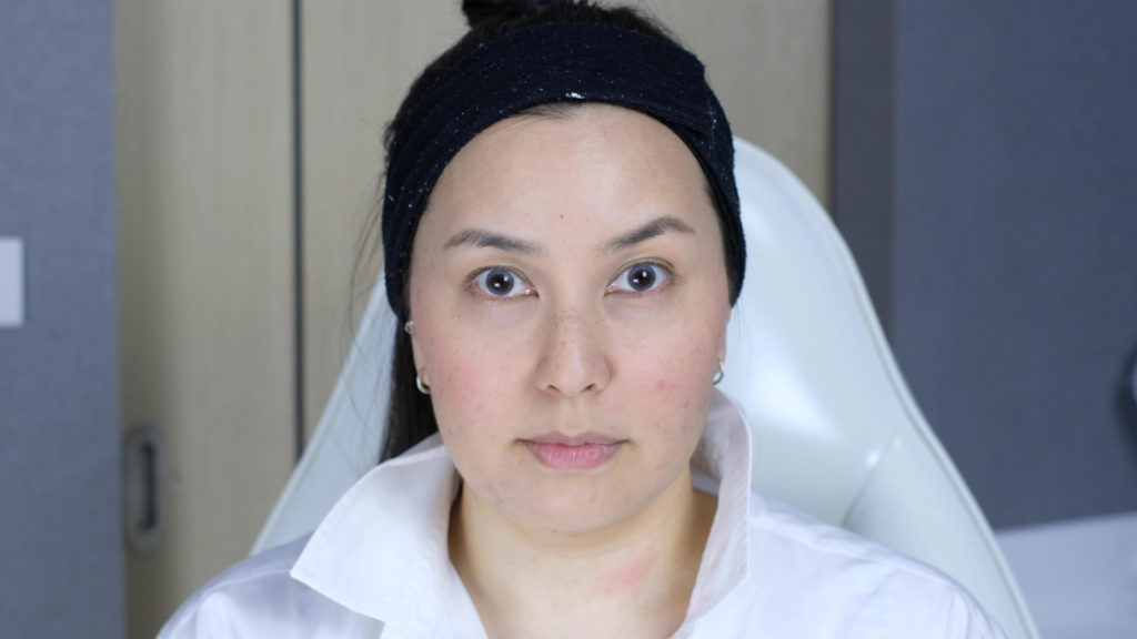 Botox and Fillers Customer Review - Lively Clinic