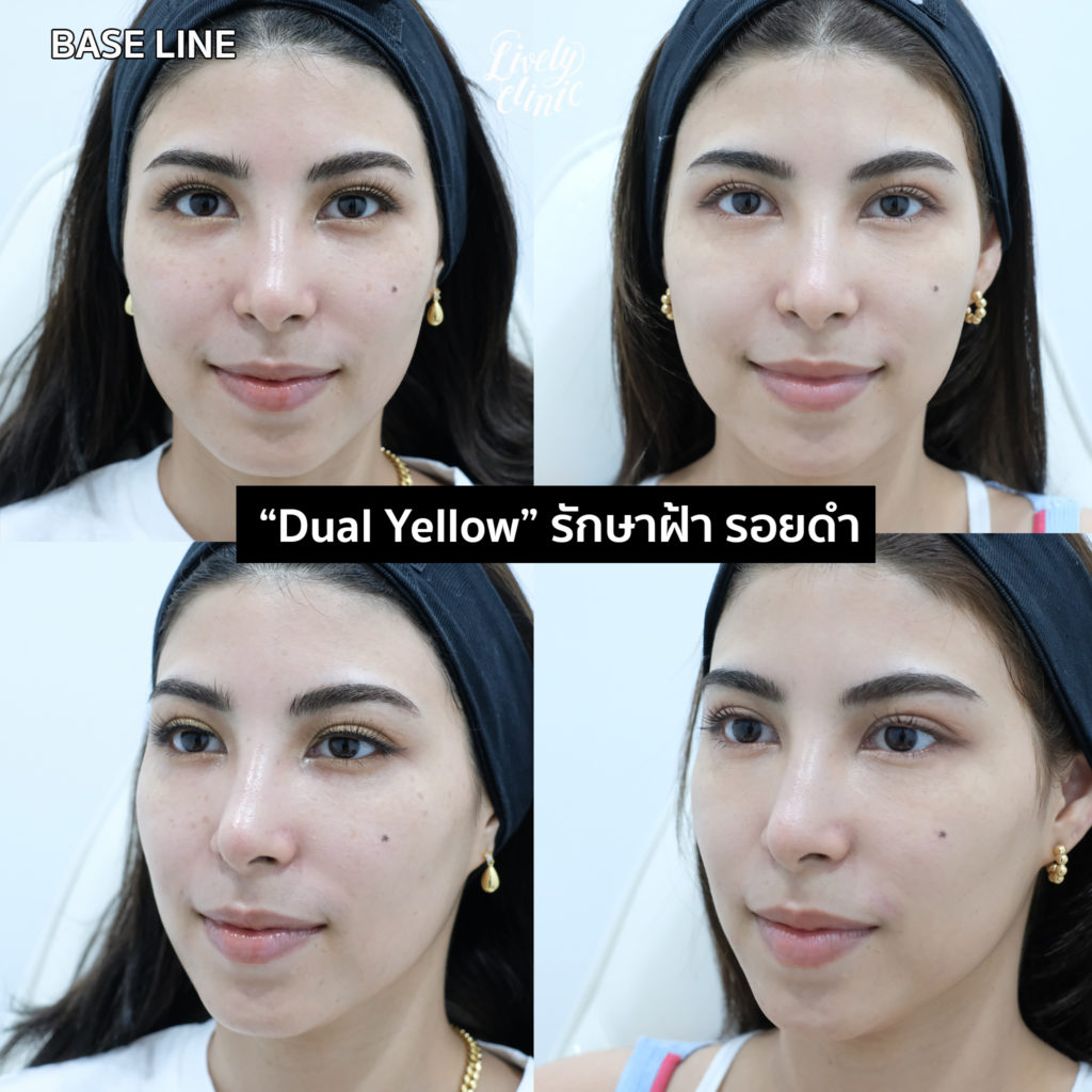 Dual Yellow Laser ลดริ้วรอย - Lively Clinic